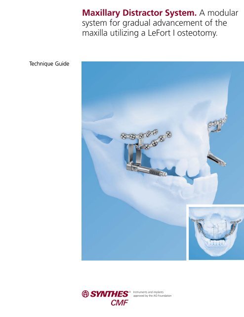 Maxillary Distractor System TG - Synthes
