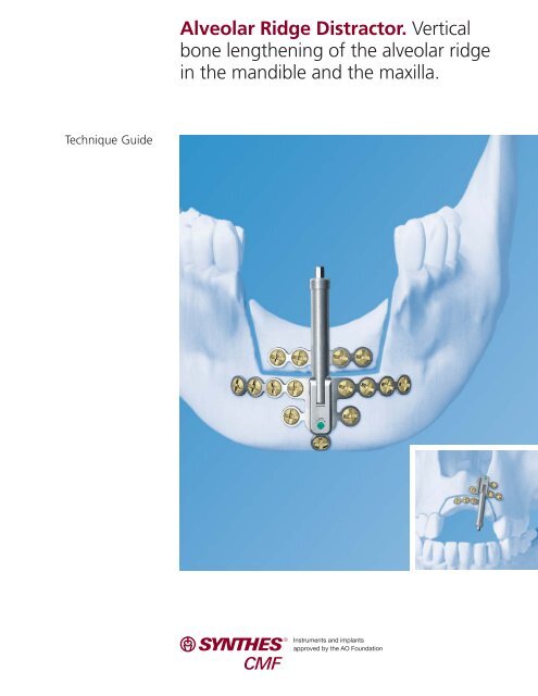 Alveolar Ridge Distractor TG - Synthes