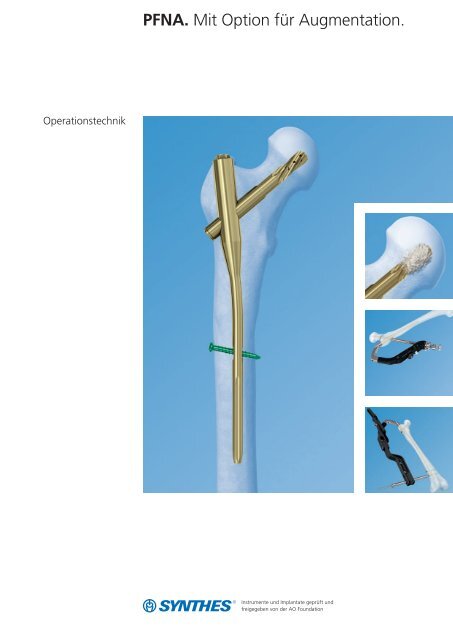PFNA. Mit Option für Augmentation. - Synthes