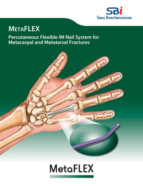 Download the MetaFLEX Product Overview - Small Bone Innovations