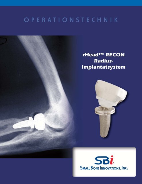 rHeadâ ¢ RECON Surgical Technique - Small Bone Innovations