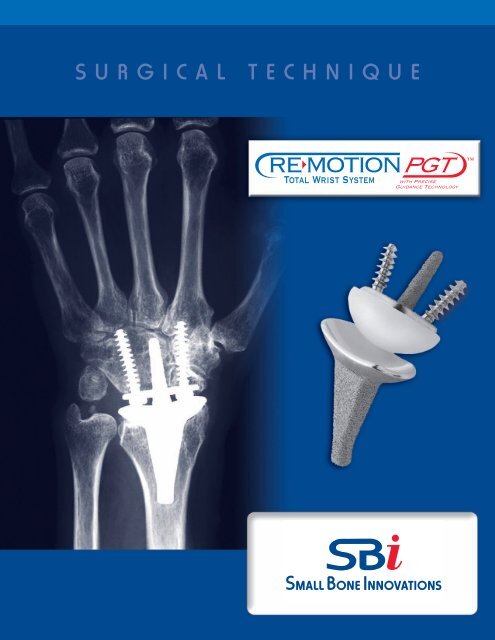 RE-MOTIONâ ¢ Total Wrist Implant System Surgical Technique