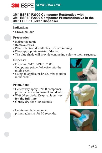 F2000 Compomer Restorative - 3M