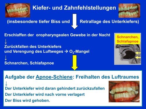 2. Wie wirkt die Protrusionsschiene?