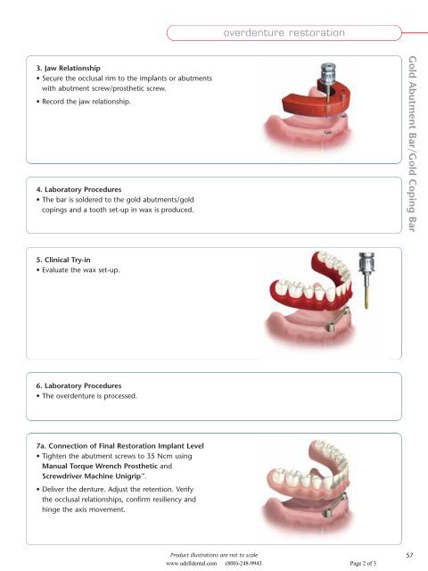 overdenture restoration 3
