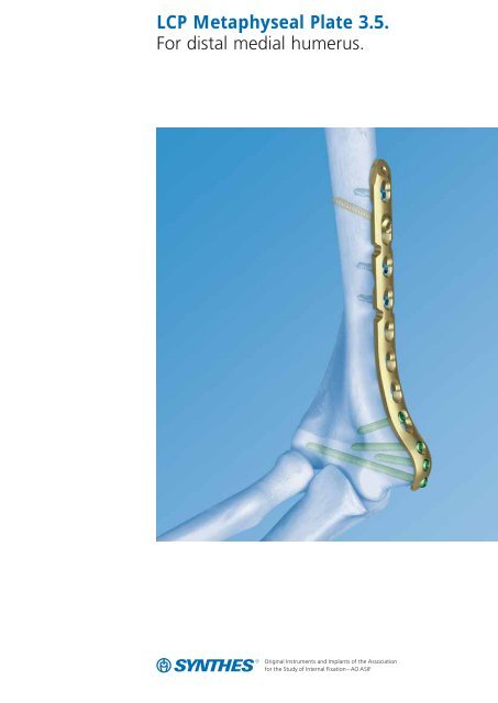 LCP Metaphyseal Plate 3.5. For distal medial humerus. - Osteosyntese