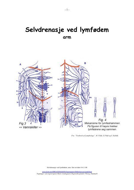 Selvdrenasje ved lymfÃ¸dem, arm.