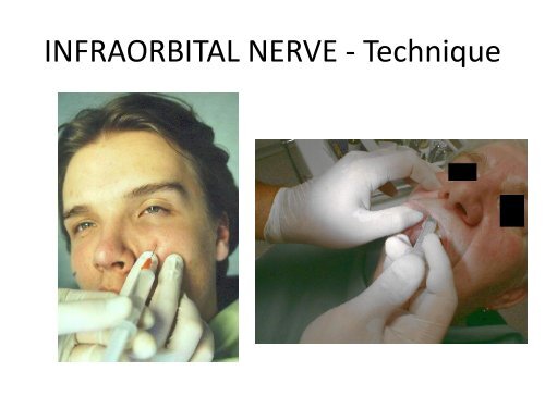 INFRAORBITAL
