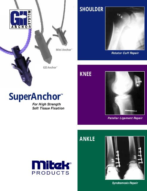 SuperAnchor, Mitek - ShoulderDoc.co.uk