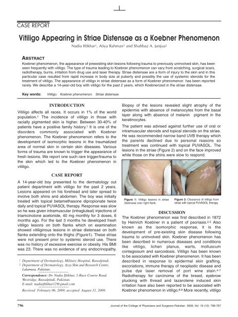 Vitiligo Appearing in Striae Distensae as a Koebner Phenomenon