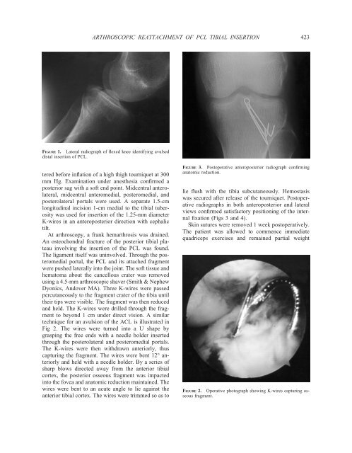 ARTHROSCOPIC REATTACHMENT