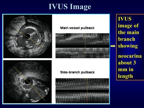 In vitro TAP stenting Per