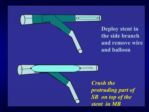 Deploy stent in the side