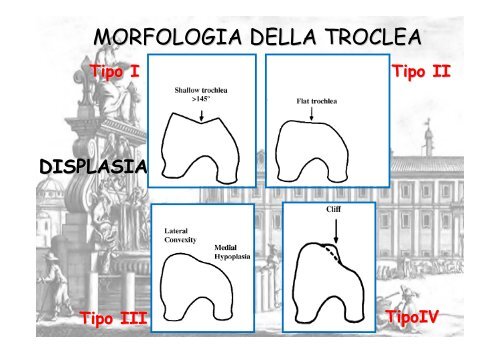 MORFOLOGIA DELLA TROCLEA