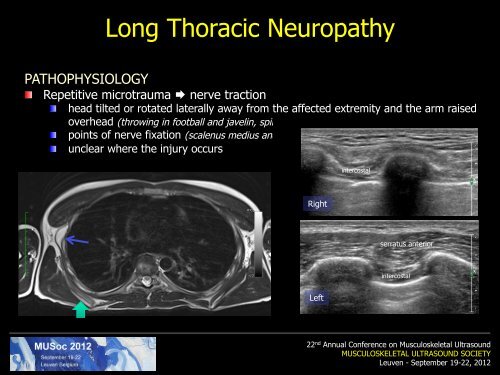 Long Thoracic Neuropathy