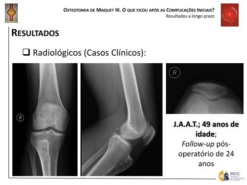 OSTEOTOMIA DE MAQUET III.