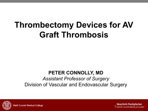 Thrombectomy Devices for AV Graft Thrombosis