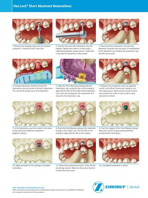 Hex-LockÃ‚Â® Short Abutment Restorations - Zimmer Dental