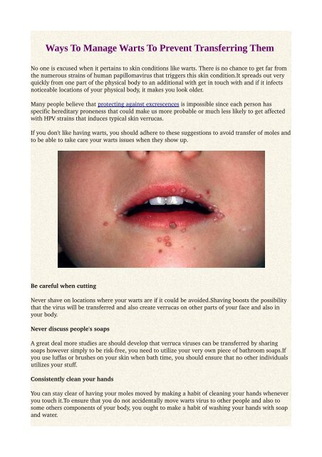 Ways To Manage Warts To Prevent Transferring Them