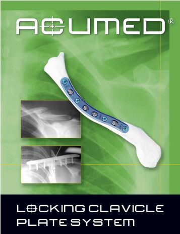 OHL OLECRANON HOOK LOCKING PLATE - ITS-Implant.com