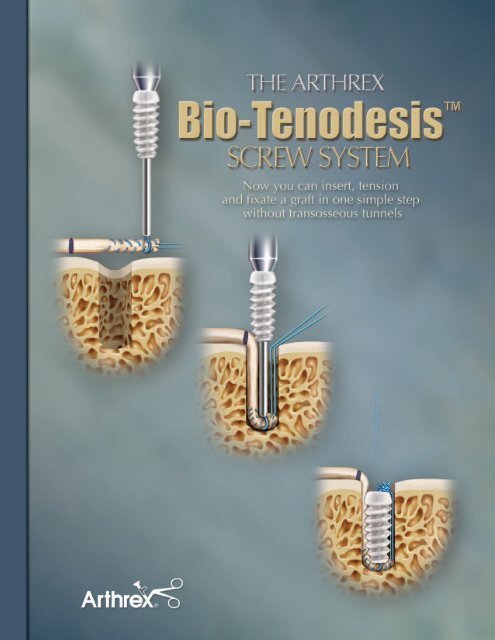 Biotenodesis, Arthrex - ShoulderDoc.co.uk