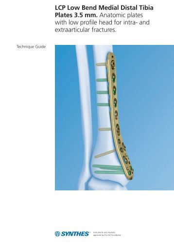 LCP Distal Ulna Plate. For capital and subcapital fractures of the ulna.