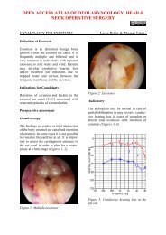 Hammer and gouge mastoidectomy for acute mastoiditis - Vula ...