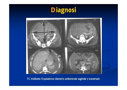 Diagnosi TC Addome: Equiv