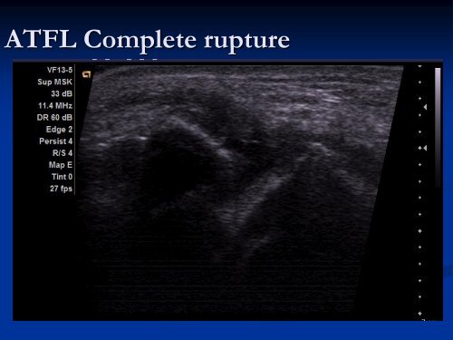 Lateral - ATFL ATFL Talus