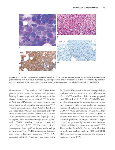 HEMATOLOGIC MALIGNANCIES