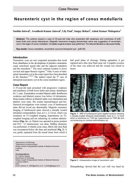 Neurenteric cyst in the region of conus medullaris - Pan Arab ...