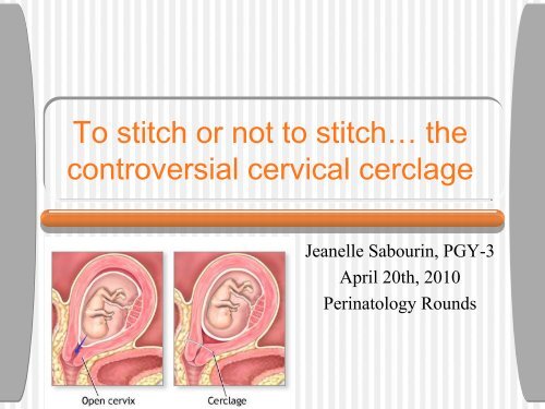 The Controversial Cervical Cerclage - Onehealth.ca