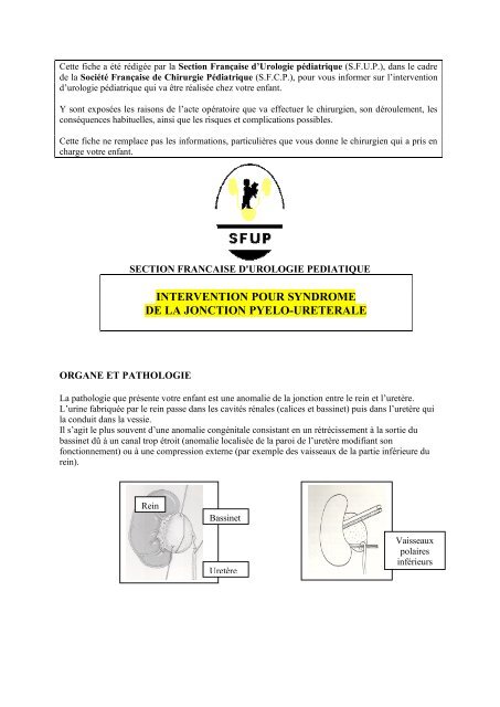 intervention pour syndrome de la jonction pyelo-ureterale - SociÃ©tÃ©