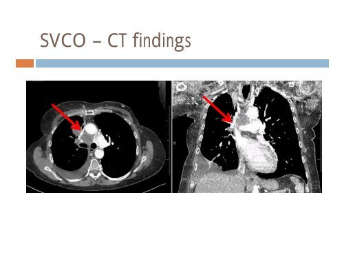 SVCO – CT findings