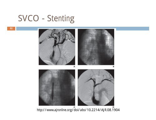 SVCO - Stenting 52 http:/