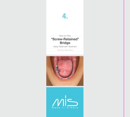 Cemented Bridge “Screw-Retained” Bridge - Mis Implants