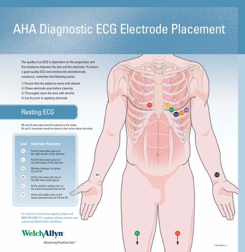 Electrode Placement Poster - Welch Allyn Electrode Placement Poster - Welch Allyn