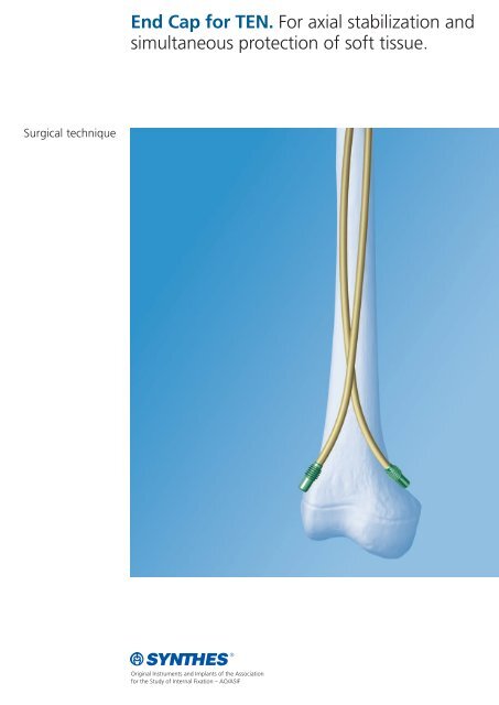 End Cap for TEN. For axial stabilization and ... - Osteosyntese