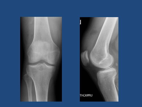 Xray Findings in Internal Derangement of the Knee