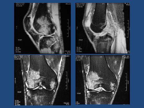 Xray Findings in Internal Derangement of the Knee