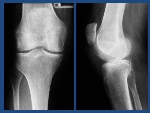 Xray Findings in Internal Derangement of the Knee