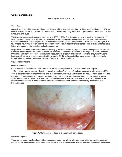 Anterior Uveitis Sarcoidosis