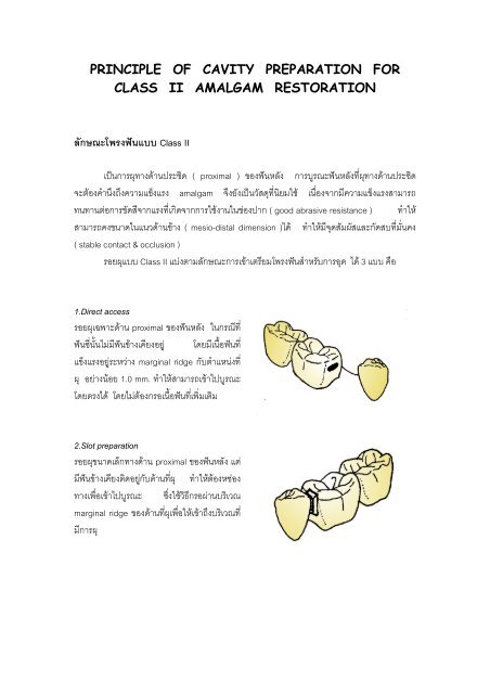 PRINCIPLE OF CAVITY PREPARATION FOR CLASS II AMALGAM ...