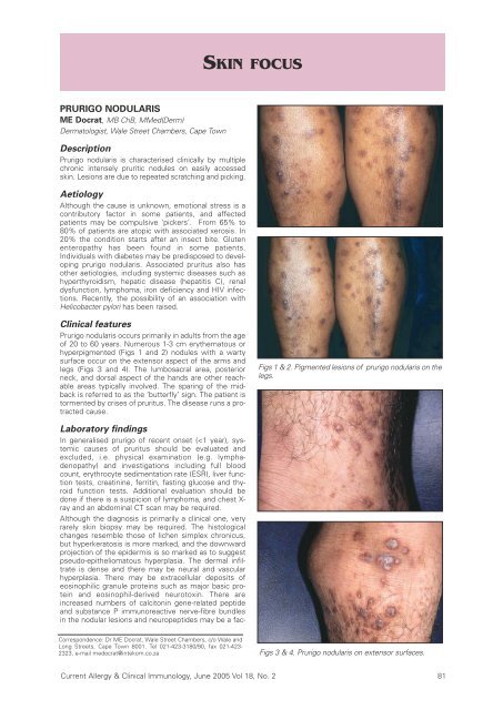 Prurigo nodularis - Allergy Society of South Africa