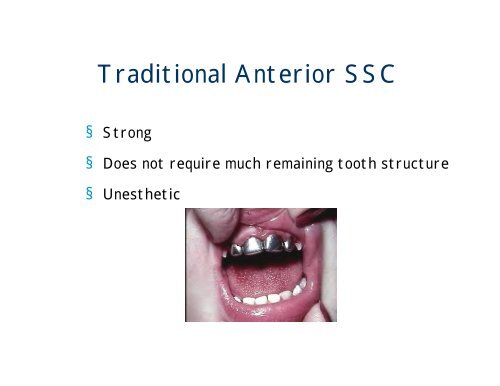 Traditional Anterior SSC