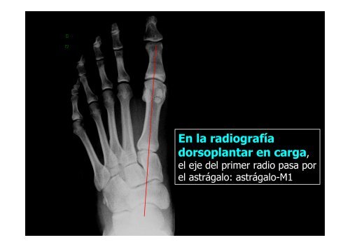 Anatomía Del Pie Por Rayos X Radiografía De Perfil En Carga