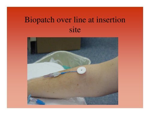 Biopatch around line at i