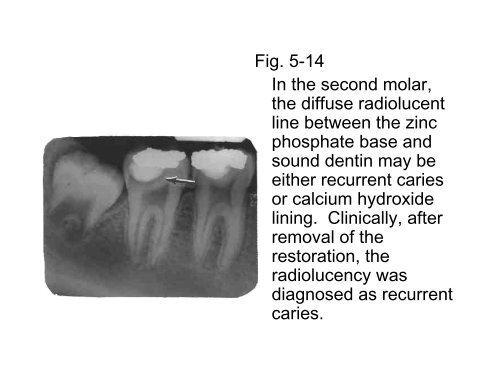 Fig. 5-13 Recurrent carie