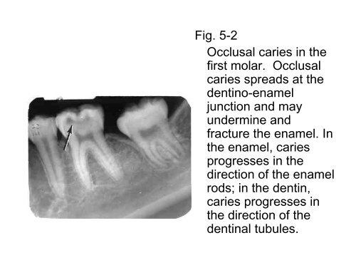 Fig. 5-1 Occlusal