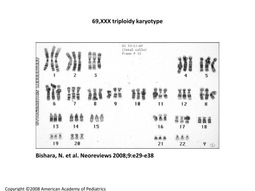 Triploidy • Triploidy i